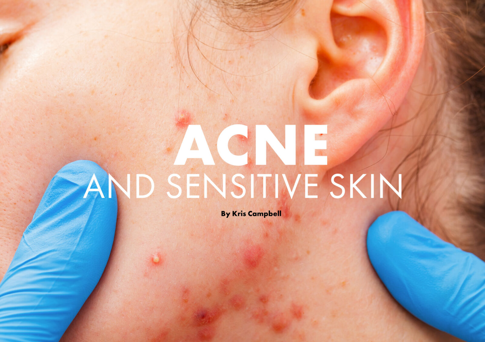 Acne and Sensitive Skin - Hale & Hush