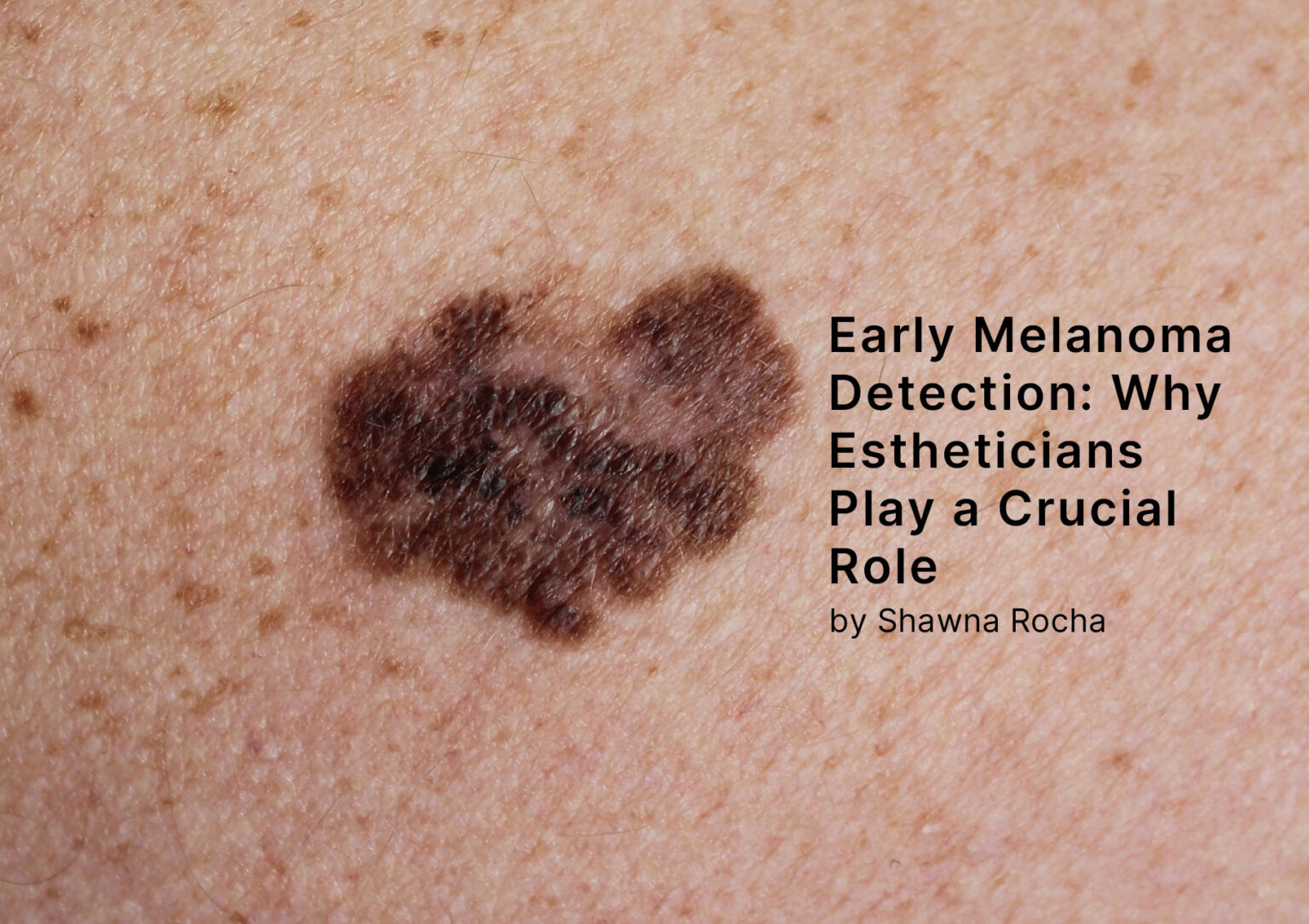Early Melanoma Detection: Why Estheticians Play a Crucial Role - Hale ...